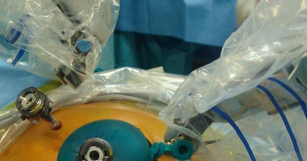 Komplizierte Bauch-OPs in Kliniken unterschiedlich gut